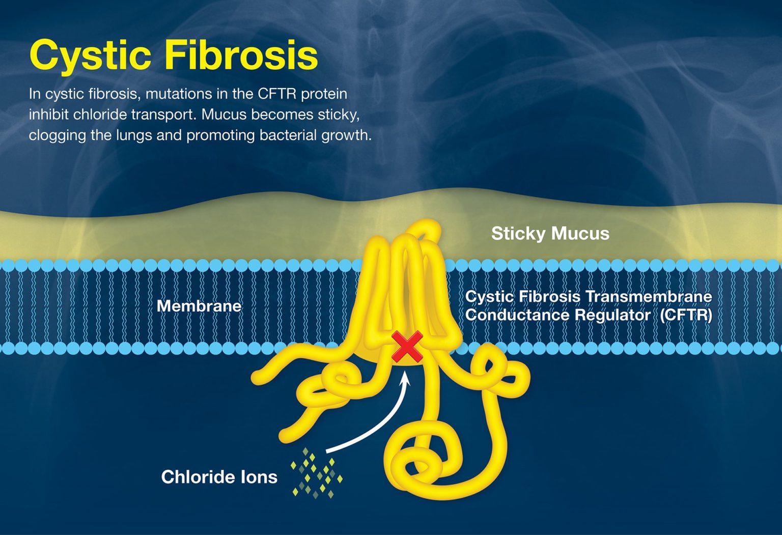 Visual explanation of how cystic fibrosis affects the lungs – Woods ... Visual explanation of how cystic fibrosis affects the lungs – Woods ...